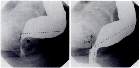 Normal Defecogram A At Rest Smooth Impression On Posterior Wall Of