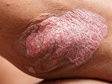 Locations And Types Of Psoriasis What To Know
