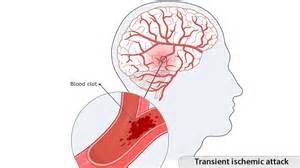 Tia Stroke Symptoms Primary Care Docs Should Watch For