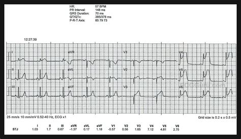 Proximal Occlusion Of Lad Ecg Guru Instructor Resources