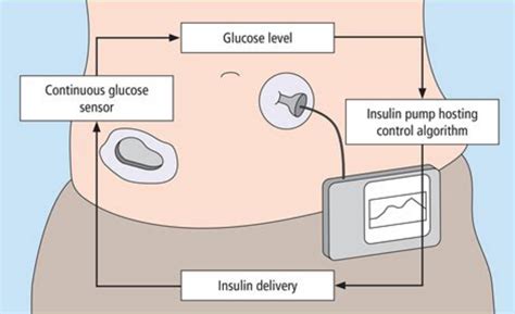 About Hybrid Closed Loop For T1d Love My Libre