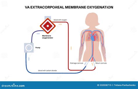 Extracorporeal Membrane Oxygenation Stock Illustration Illustration