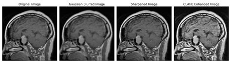 Brain Sciences Free Full Text Brain Tumor Classification From Mri Using Image Enhancement