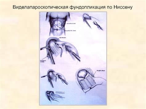 Дисфагия Растройство любой фазы акта глотания