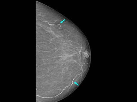 Atlas Of Breast Cancer Early Detection