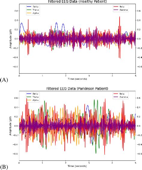 Parkinsons Disease Detection Via Resting State Electroencephalography