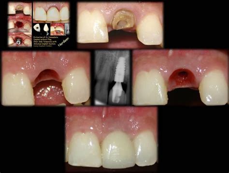 Gallery Dental Implants Uptown Guelph Dental