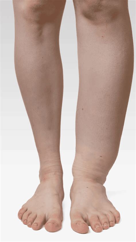 7 Ways To Treat Leg Lymphedema And Reduce Swelling Cancer Rehab Pt