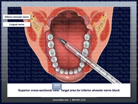 Inferior Alveolar Nerve Block Trialquest Inc