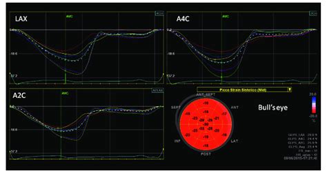 Automated Function Imaging Afi Of Left Ventricular 2 D Strain Of Download Scientific Diagram