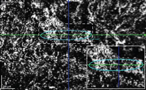 Multimodal Imaging Of Vascularized Inner Retinal Layer IRL IRL Download Scientific Diagram