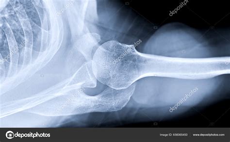 Shoulder Joint X Ray