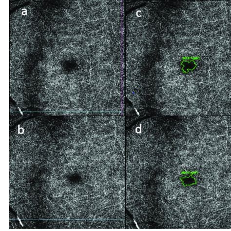 Swept Source Optical Coherence Tomography Angiography Images Showing A Download Scientific