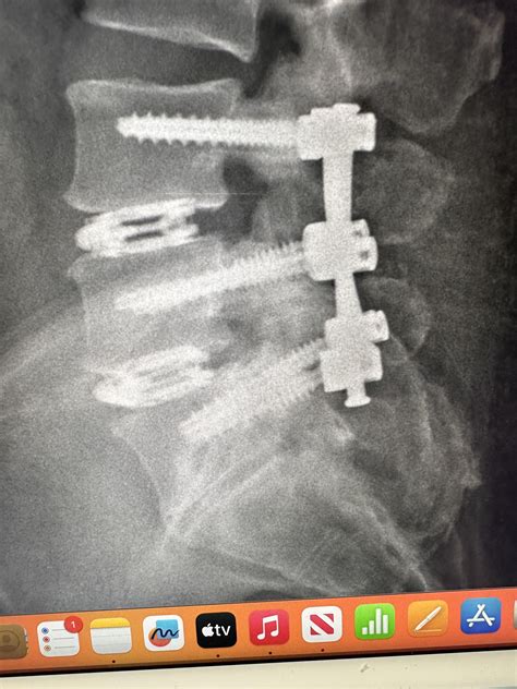 5 Weeks Post Op L3 L5 Tlif R Spinalfusion