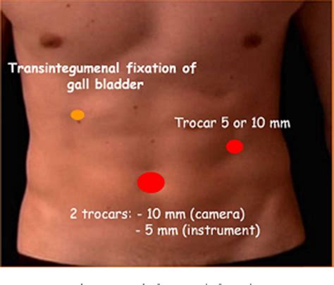Figure 1 From Two Sites Incision Laparoscopic Cholecystectomy Semantic Scholar