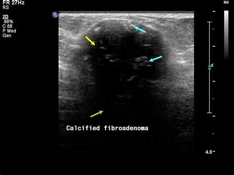 Atlas Of Breast Cancer Early Detection