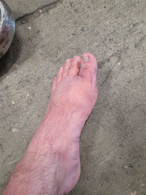 Squashed My Foot With An Epj At Work R Wellthatsucks