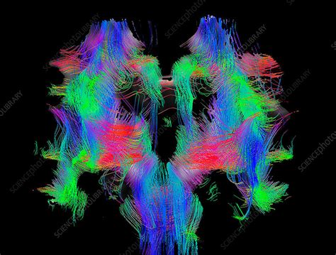 Brain Fibre Tracts Dti Scan Stock Image C036 7005 Science Photo Library