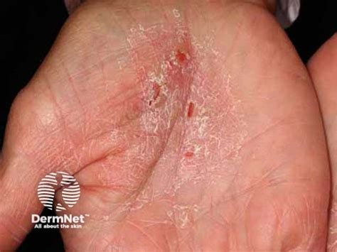 Hand Dermatitis Images
