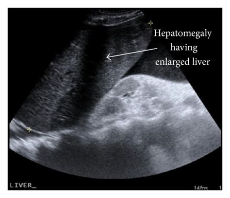 Ultrasound Image Of A Normal Liver B Fatty Liver C Cirrhosis Download Scientific