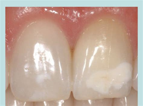 Operative Non Cavitated Vs Cavitated Lesions Flashcards Quizlet