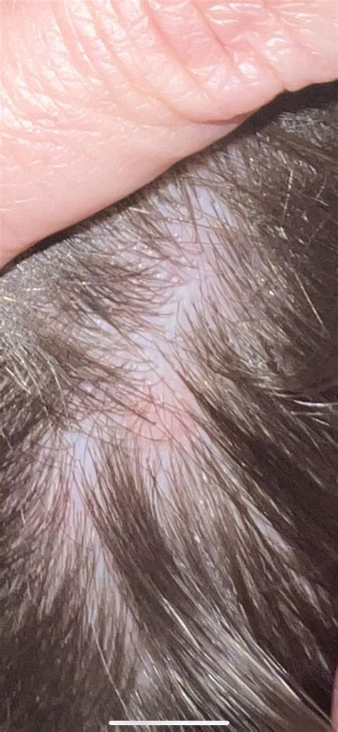 Lump On My Scalp Anyone Have Any Ideas R Dermatologyquestions