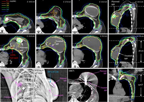 Case Report Cumulative Proton Dose Reconstruction Using Cbct Based Synthetic Ct For