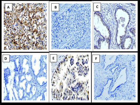 Microphotographs Of Ihc Reaction For Sv 40 Large T Ag In Prostatic Download Scientific Diagram