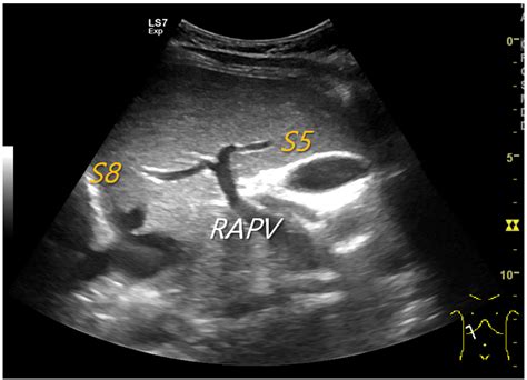 초음파 간liver 스캔법 Metamedic
