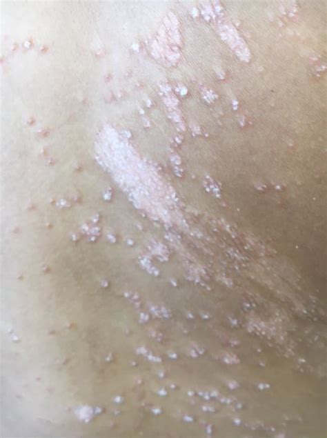 بیماری پسوریازیس داء الصدف کلینیک تخصصی پوست مو و زیبائی دکتر محمد