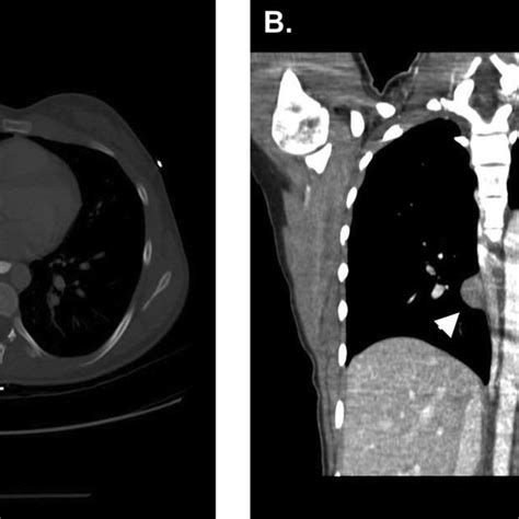 Pdf Excision Of Esophageal Duplication Cysts With Robotic Assisted Thoracoscopic Surgery