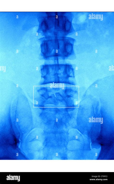 COMPRESSION FRACTURE X RAY Stock Photo Alamy