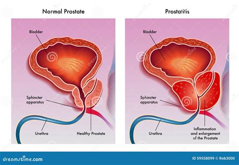 Prostatitis Stock Vector Illustration Of Asymptomatic 59558099