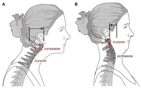 What Are The Deep Neck Flexors