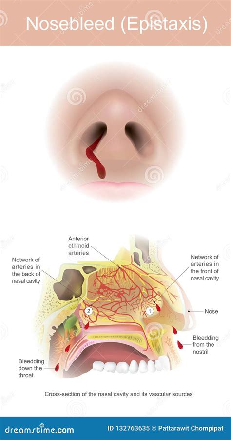 Bleeding From The Sinuses Is Caused By The Tear Of The Arteries Stock