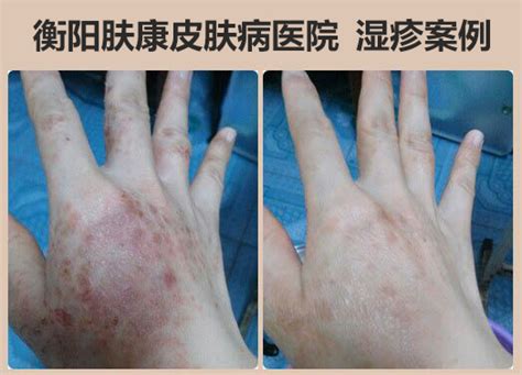 中医怎么治湿疹 随意云