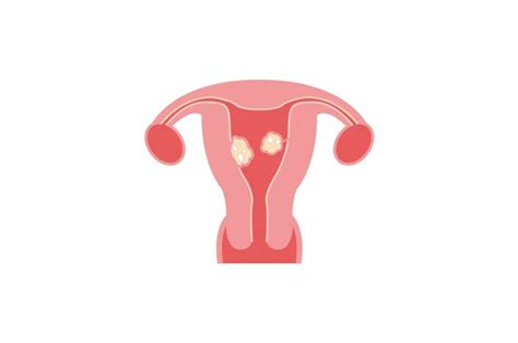 Uterine Fibroid Scans Evidence Fibroids Information