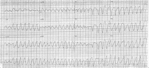Polymorphic Ventricular Tachycardia Ecg