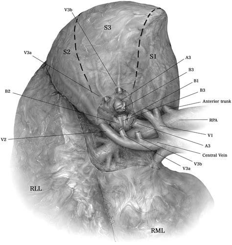 Minimally Invasive Complex Segmentectomies Of The Right Upper Lobe