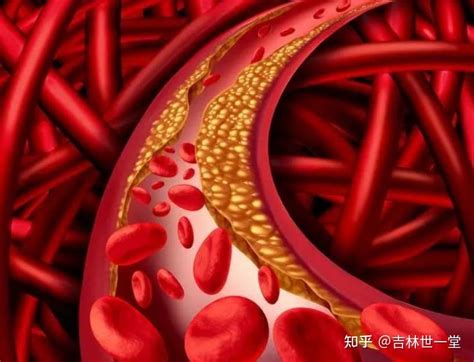 高血糖是怎么伤血管的？ 知乎