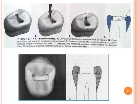 Class I Cavity Preparation Pptx
