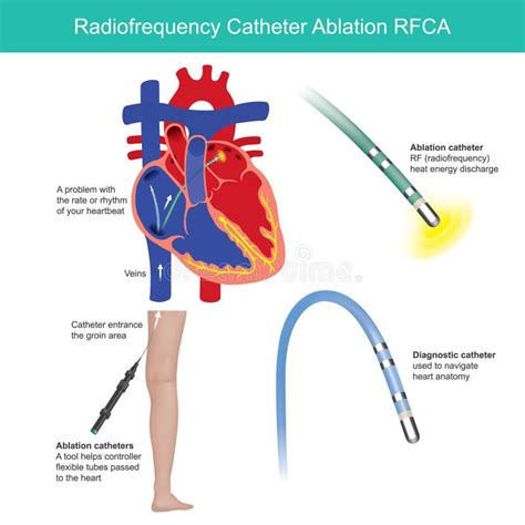 Radio Frequency Catheter Ablation Medical Procedure Stock