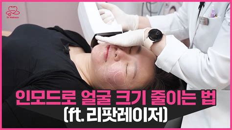 팔자주름마리오넷 주름 없애기 실리프팅 말고 살리프팅으로 해결 전후리프팅후 검버섯제거 Youtube