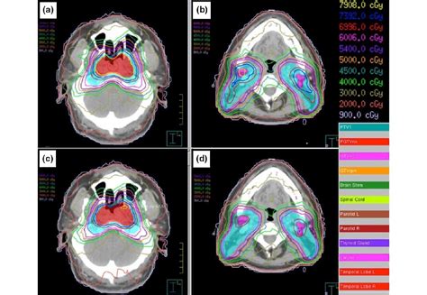 Optimizing Mlc Leaf Speed Could Improve Radiotherapy Plan Quality