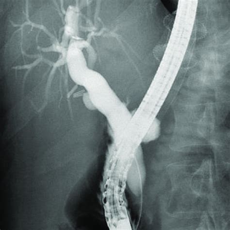 Ultrasound Of Dilated Cbd Contain Stent Arrow And Stone Download