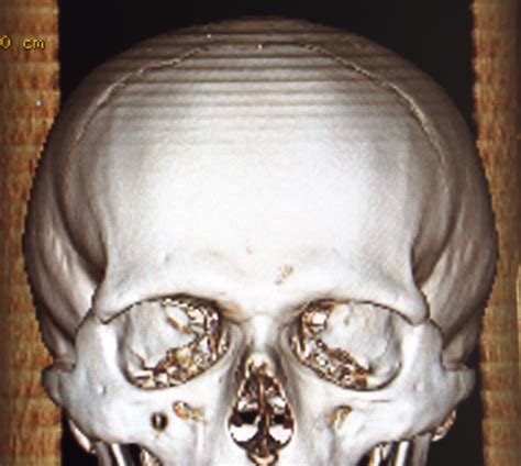 Wide Convex Temporal Bones 3d Ct Scan Dr Barry Eppley Explore Plastic