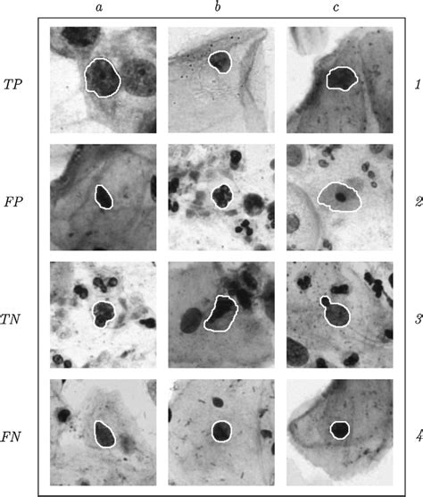 Classification Results For A Number Off Nuclei From The Lbc And Smear Download Scientific