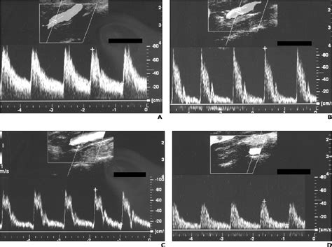 Pdf A Spectrum Of Doppler Waveforms In The Carotid And Vertebral Arteries Semantic Scholar