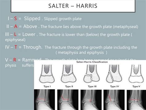 X Ray Diagnostics Of Fractures And Dislocations Pptx