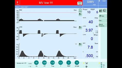 Synchronized Intermittent Mandatory Ventilation Simv Youtube